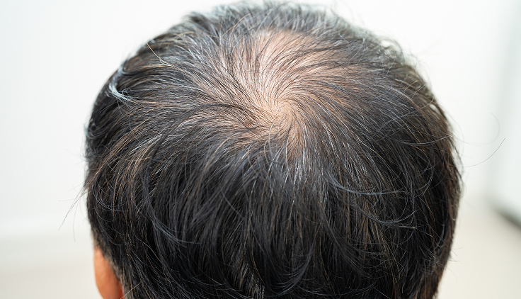 Alopecia Androgénica: Causas, Síntomas y Tratamiento - Capilea